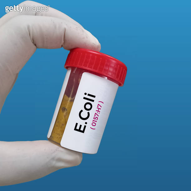 Stool sample for Escherichia coli (E. coli) O157:H7 test. Serotype of ...