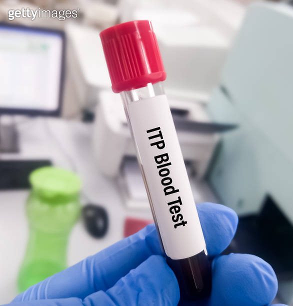 Blood sample for Immune Thrombocytopenic Purpura (ITP) test, idiopathic ...