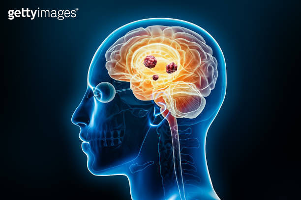 Cancer brain with cancerous cells or tumors x-ray 3D rendering ...