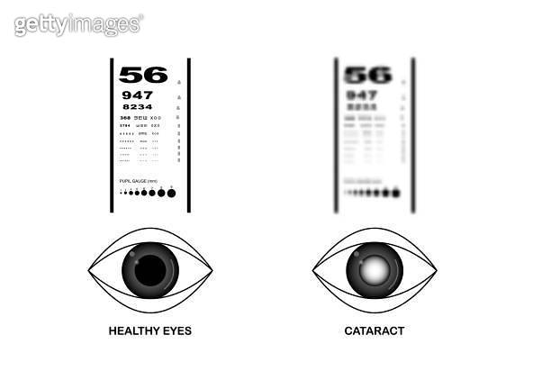Comparison of healthy eyes and cataract eyes vision on eye examination ...