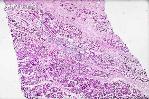 Atrophy of skeletal muscle human pathology sample under microscope ...