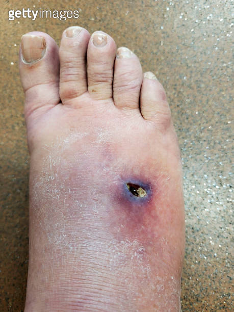 Tissue necrosis caused by a Stingray whip injury four weeks previously ...