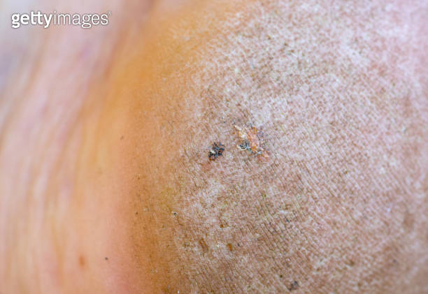 Calluses with athlete's foot and warts on the foot 이미지 (1495360030 ...