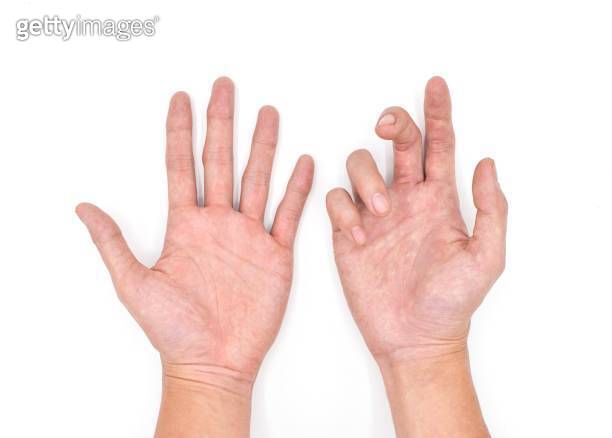 Ulnar claw hand of Asian young man. also known as 'spinster's claw ...