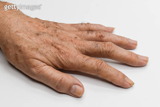 Age spots on hand of Asian elder man. They are brown, gray, or black ...