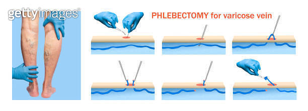 Ambulatory Phlebectomy Treatment for varicose vein. 이미지 (1584064106 ...