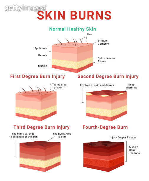 Skin burn classification infographic medical educational scheme poster ...
