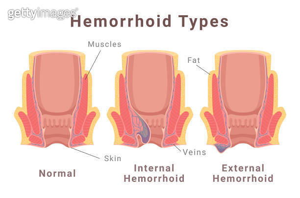 Hemorrhoid types scheme with normal internal and external poster ...