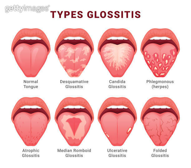 Glossitis type candidiasis of tongue thrush inflammation educational ...