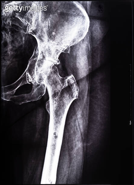 negative x-ray of junction of tibia and pelvis (1488608710) - 게티이미지뱅크