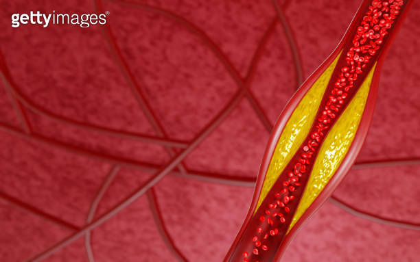 Hyperlipidemia. Blocked artery concept and human blood vessel as a ...