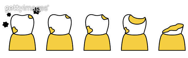 Illustration of image of cavity progression, simple line drawing 이미지 ...
