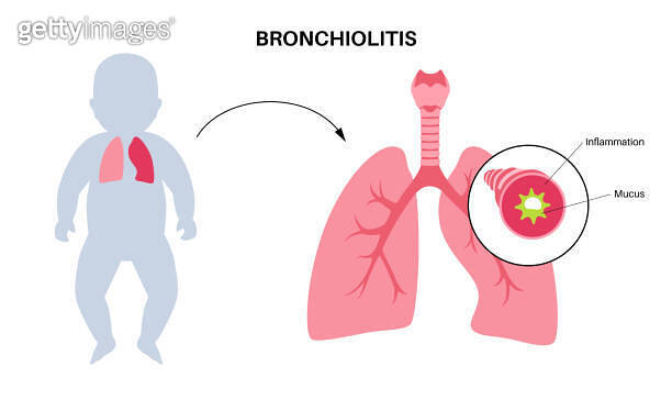 Bronchiolitis lung disease 이미지 (1484959594) - 게티이미지뱅크