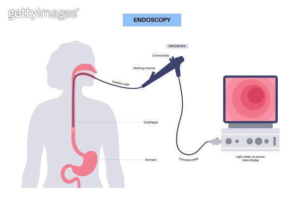 Gastroscopy endoscopy procedure 이미지 (1502674841) - 게티이미지뱅크