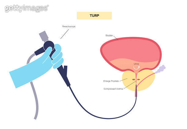 Transurethral resection of the prostate (1699425771) 일러스트, 무료 일러스트 - 게티 ...