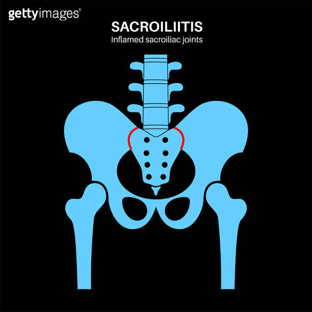 Sacroiliitis medical poster 이미지 (1742633416) - 게티이미지뱅크