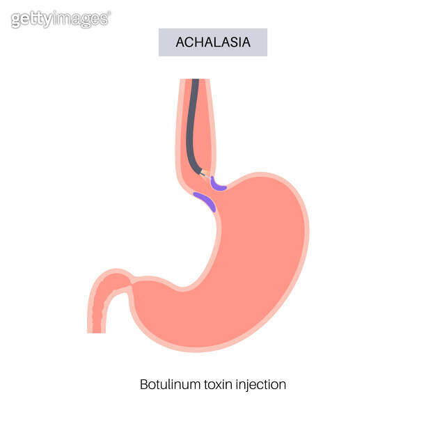 esophageal botulinum toxin injection (1605806011) - 게티이미지뱅크