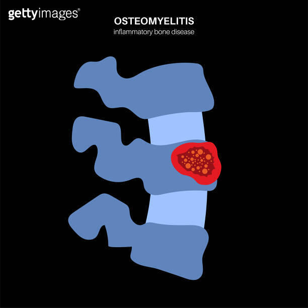 Vertebral osteomyelitis poster (1717643578) 일러스트, 무료 일러스트 - 게티이미지뱅크