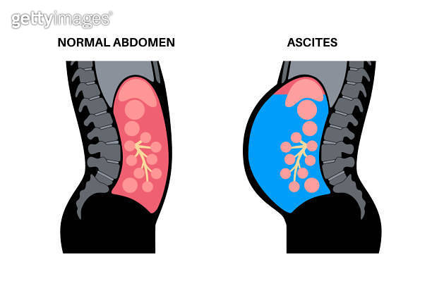Ascites disease poster 이미지 (1497151103) - 게티이미지뱅크