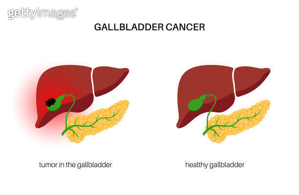 gallbladder cancer anatomy 이미지 (1485247197) - 게티이미지뱅크
