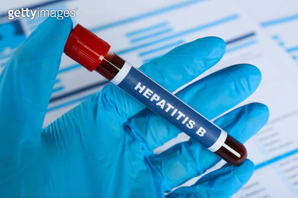 Scientist holding tube with blood sample and label Hepatitis B against ...