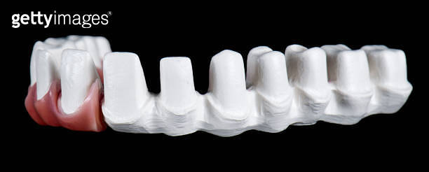emax natural look crowns on implants (1703548105) - 게티이미지뱅크