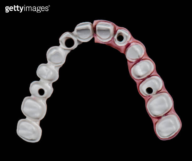 emax natural look crowns on implants (1703548622) - 게티이미지뱅크