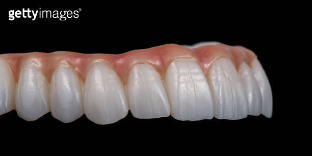 emax ceramic bridge on implants 이미지 (1485821609) - 게티이미지뱅크