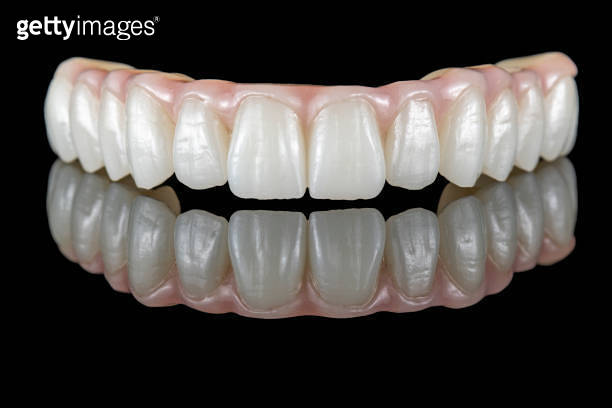 emax natural look crowns on implants (1703545881) - 게티이미지뱅크