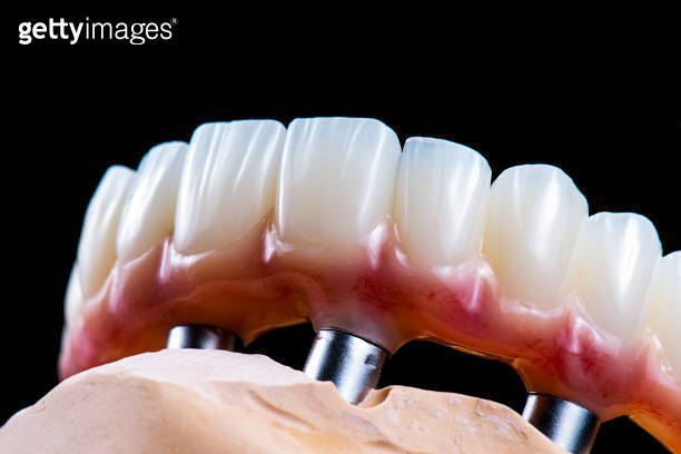 dental photography of full arch zircon bridge on implants 이미지 ...
