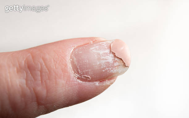 Close up view of layers peeling off damaged finger nail after UV nail ...