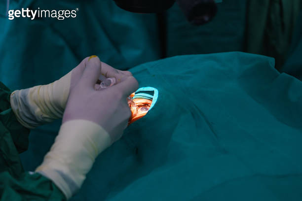 Doctor surgical operation eye lens replacement, intraocular lens ...