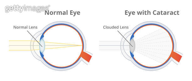 Anatomical illustration of a normal healthy eye and eye with cataract ...
