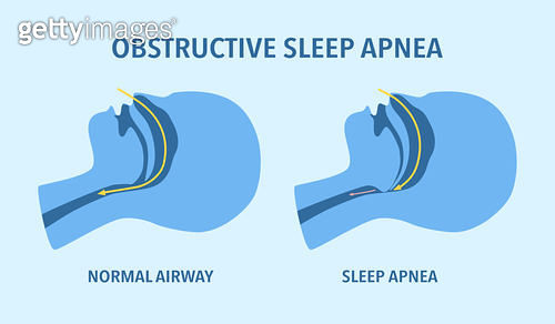 Obstructive sleep apnea concept. Sleep disorder. 이미지 (1749322753) - 게티이미지뱅크