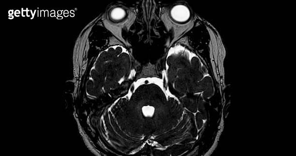 MRI scan of the internal auditory canal (IAC) . (1716021957) - 게티이미지뱅크