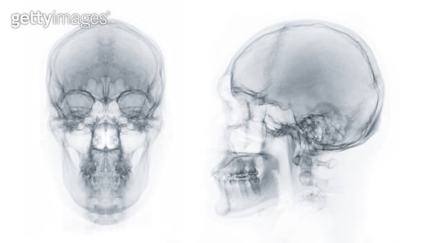 X-ray image of Human Skull AP and Lateral view for diagnosis skull ...
