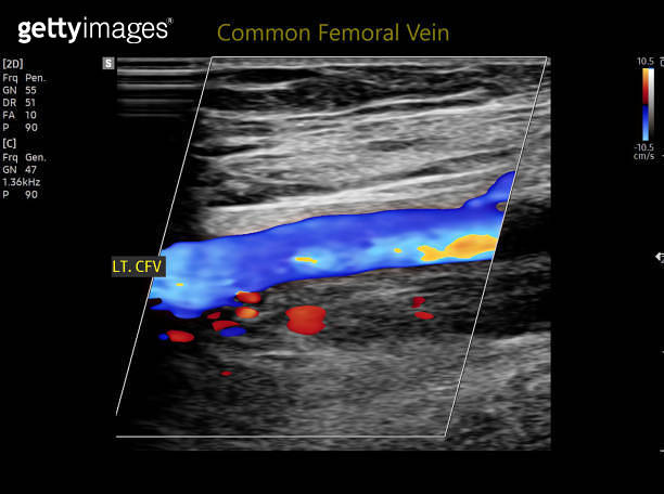 Color Doppler ultrasound determination in deep vein thrombosis patients ...