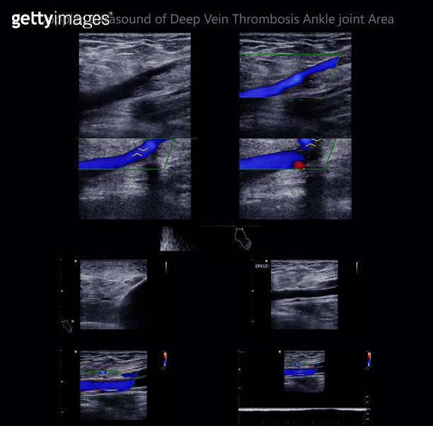 Color Doppler ultrasound determination in deep vein thrombosis patients ...