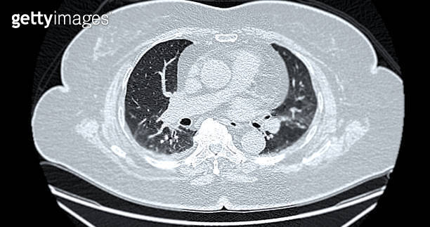 CT scan of Chest axial view for diagnostic Pulmonary embolism (PE ...