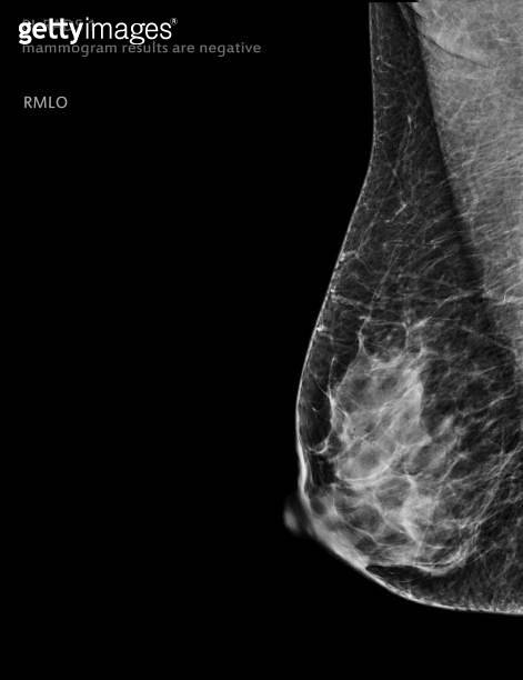 X-ray Digital Mammogram left side MLO view . 이미지 (1603345779) - 게티이미지뱅크