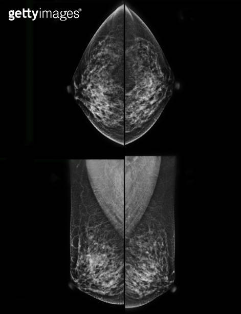 X-ray Digital Mammogram of both CC and MLO view . mammography or breast ...