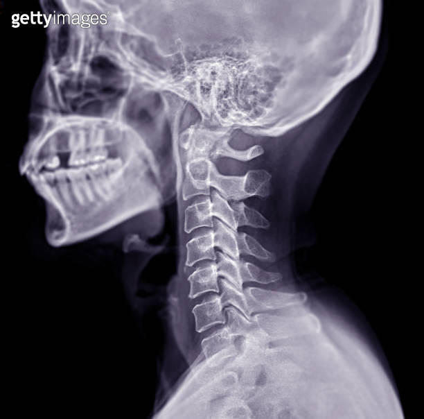 X-ray C-spine or x-ray image of Cervical spine lateral view for ...