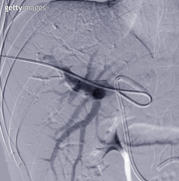 Portal Vein Embolization (PVE) is a medical procedure used to remaining ...