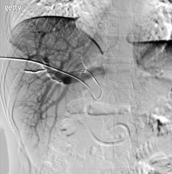 Portal Vein Embolization (PVE) is a medical procedure used to remaining ...