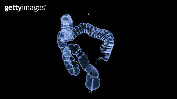 CT colonography 3D rendering image for annual health check-ups to ...