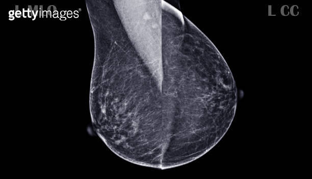 X-ray Digital Mammogram or mammography of Left Normal breast showing ...