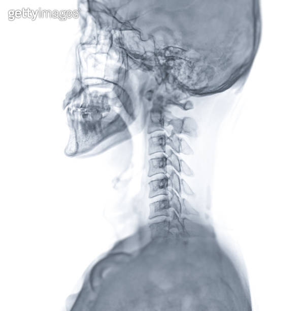 X-ray C-spine or x-ray image of Cervical spine lateral view for ...