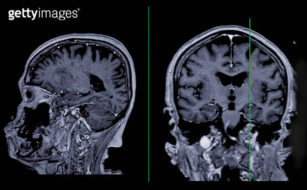 MRI brain scan Sagittal and coronal view with reference line for detect ...