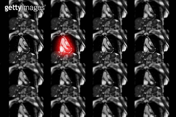 MRI heart or Cardiac MRI ( magnetic resonance imaging ) of heart for ...