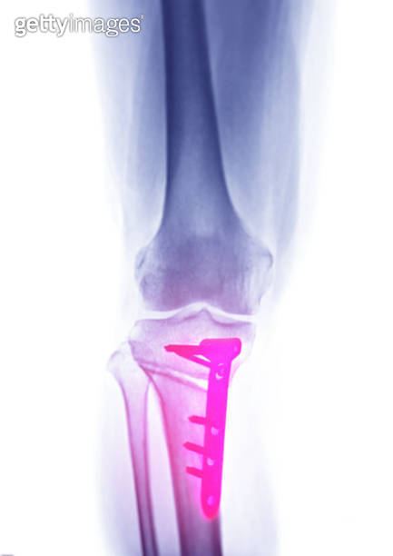 X-ray image of Right knee AP view showing Total knee arthroplasty and ...